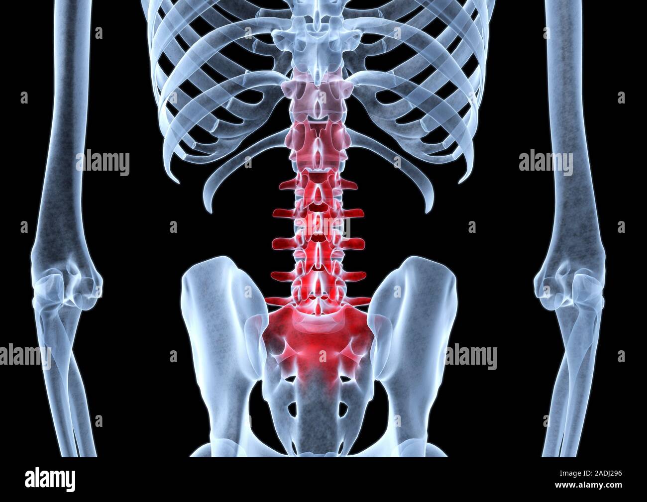 Back pain. Computer X-ray artwork of the rear view of the lower back of ...