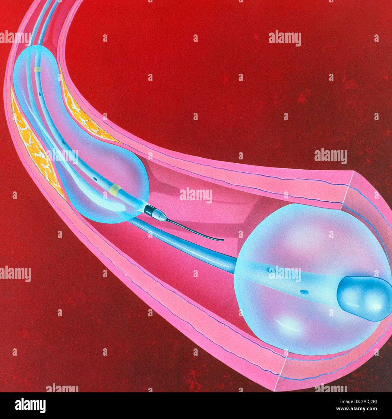 Two-balloon angioplasty. Illustration of two balloon catheters being ...