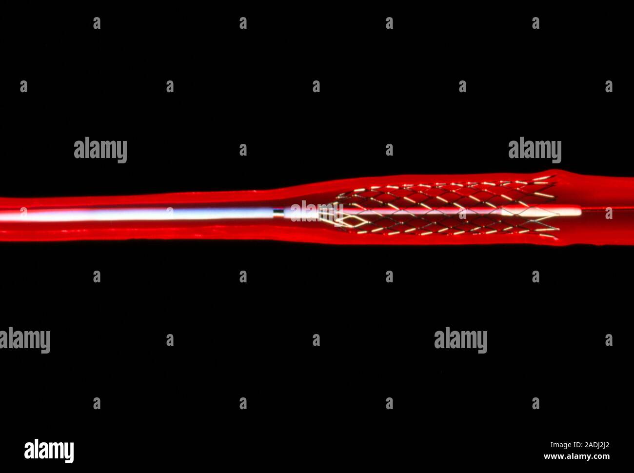 Coronary artery stent. Model of a coronary artery stent being implanted ...