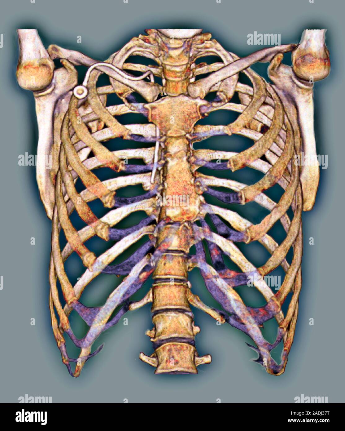 Permanent chest catheter. Coloured frontal 3D computed tomography (CT ...