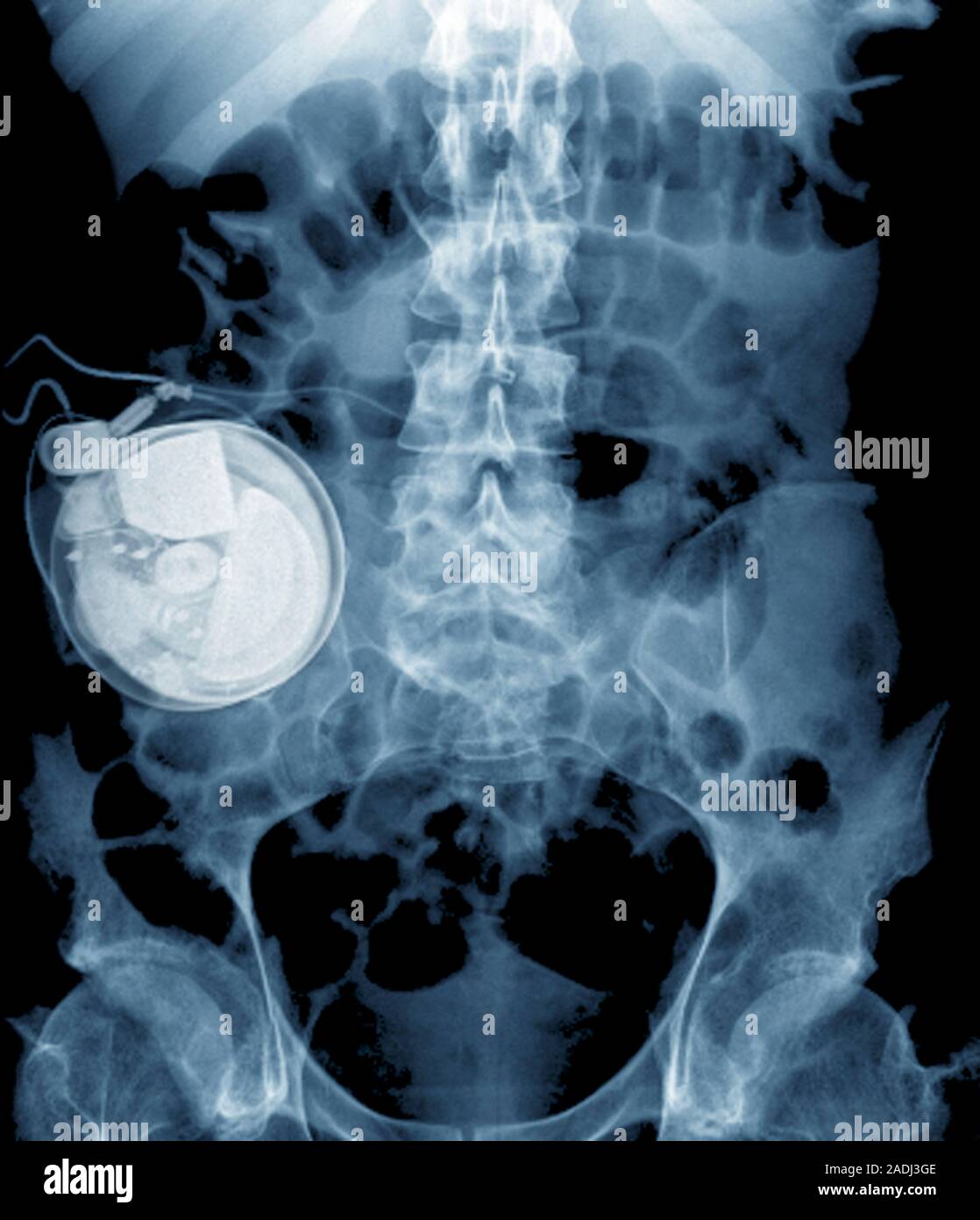 Intrathecal drug delivery. X-ray of a morphine pump (centre left ...
