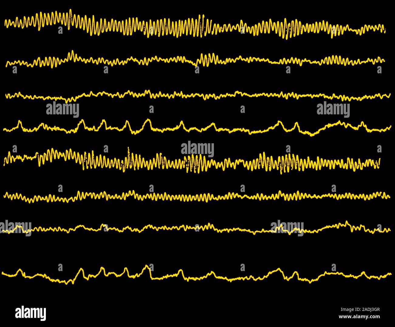 Normal electroencephalogram (EEG) read-out of the brain's alpha waves ...