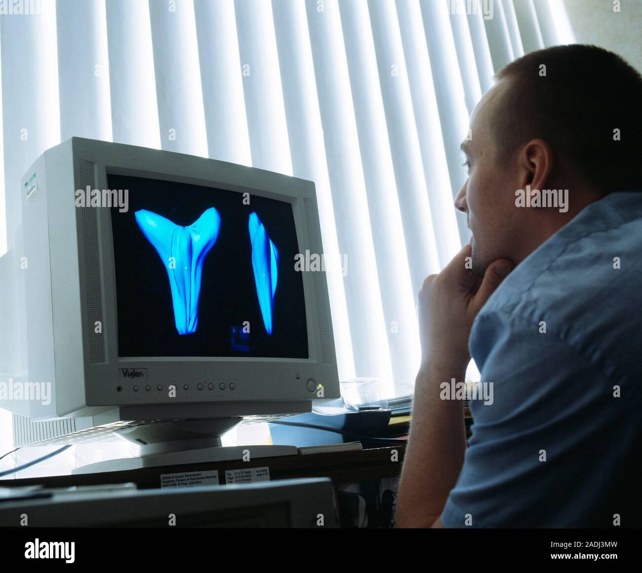 Ultrasound scan of a uterus being examined by a gynaecologist. This 3-D ...