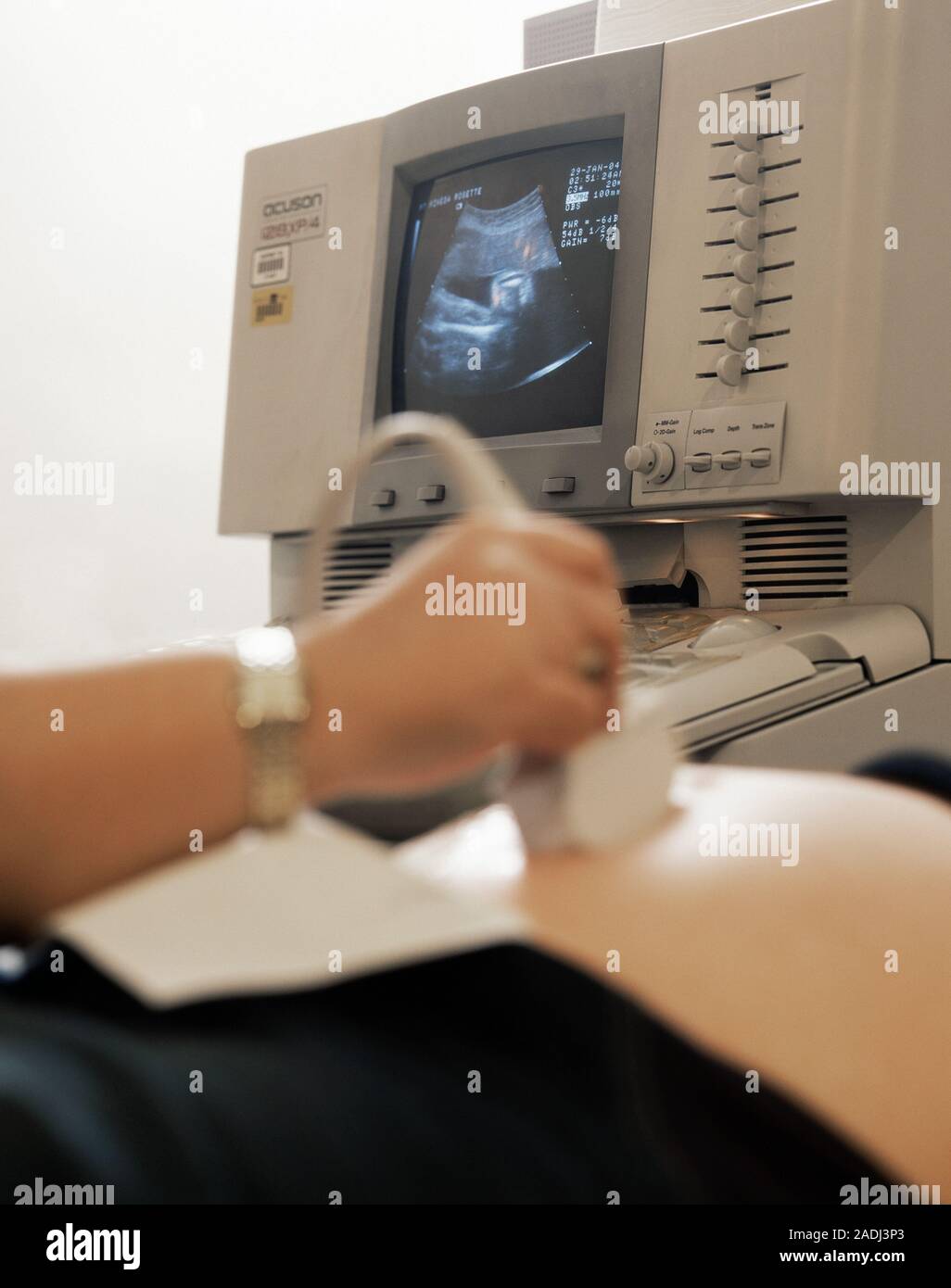 Pregnancy ultrasound. Transducer (in hand) being used to scan the ...