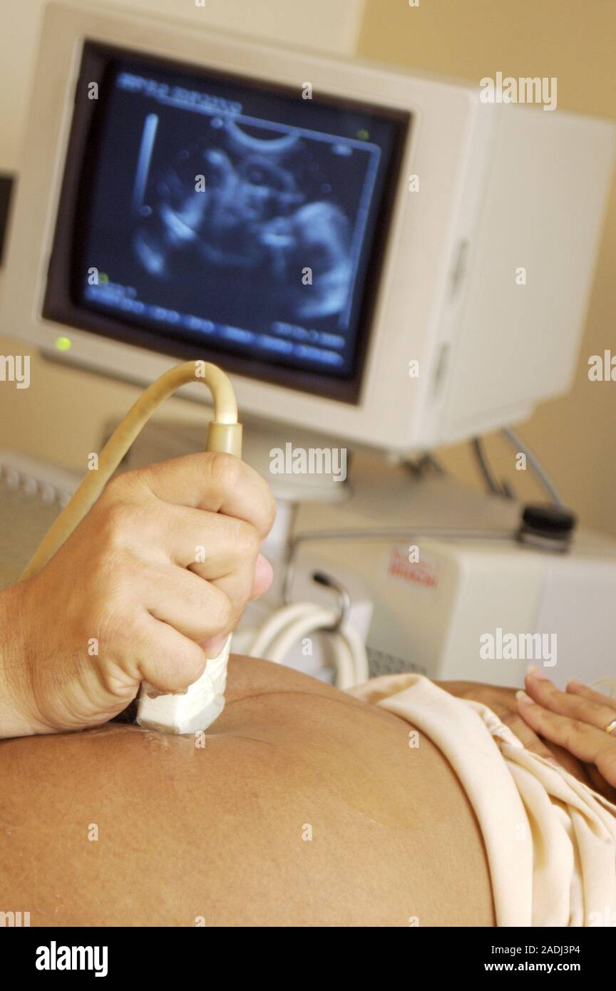 Pregnancy ultrasound. Transducer (in hand) being used to scan the ...