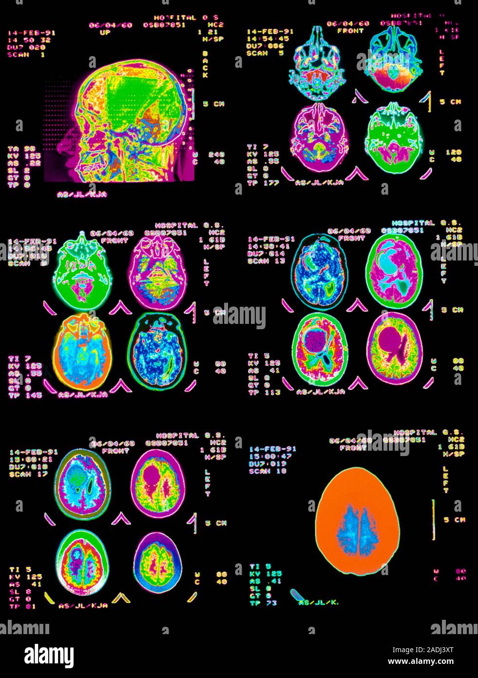 CT brain scans. Assortment of coloured computed tomography (CT) scans ...