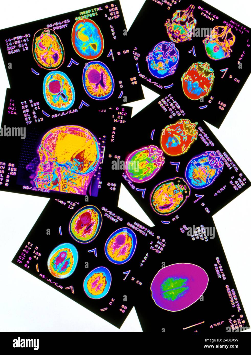 CT brain scans. Assortment of coloured computed tomography (CT) scans of the human brain, seen ...