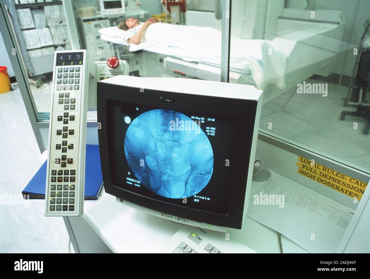 Bladder X-ray examination. Pelvic X-ray showing a catheter being passed ...