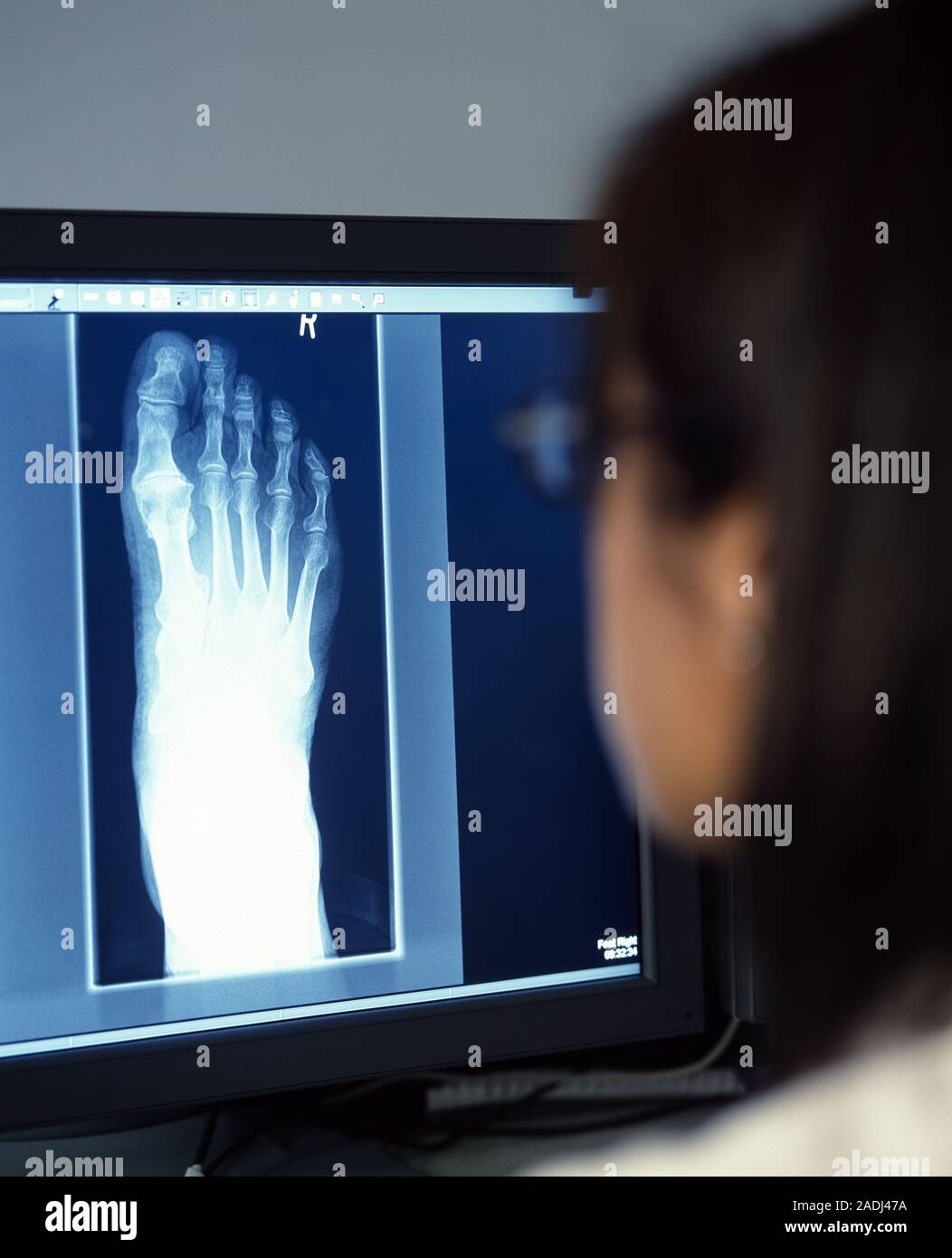 Foot X-ray being examined for signs of injury by a radiologist, using a ...