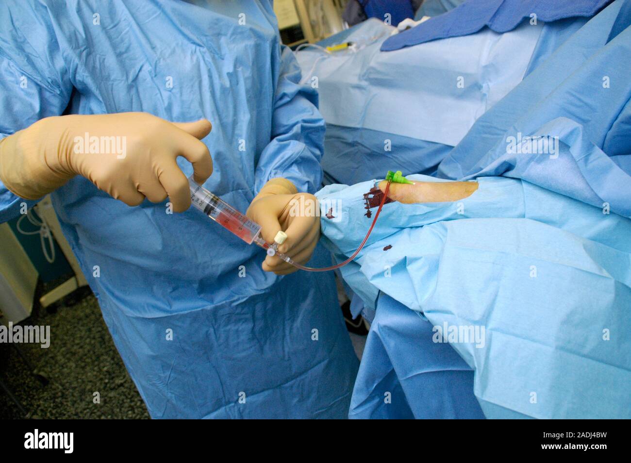 Coronary angiography. Surgeon injecting contrast medium into a wire ...