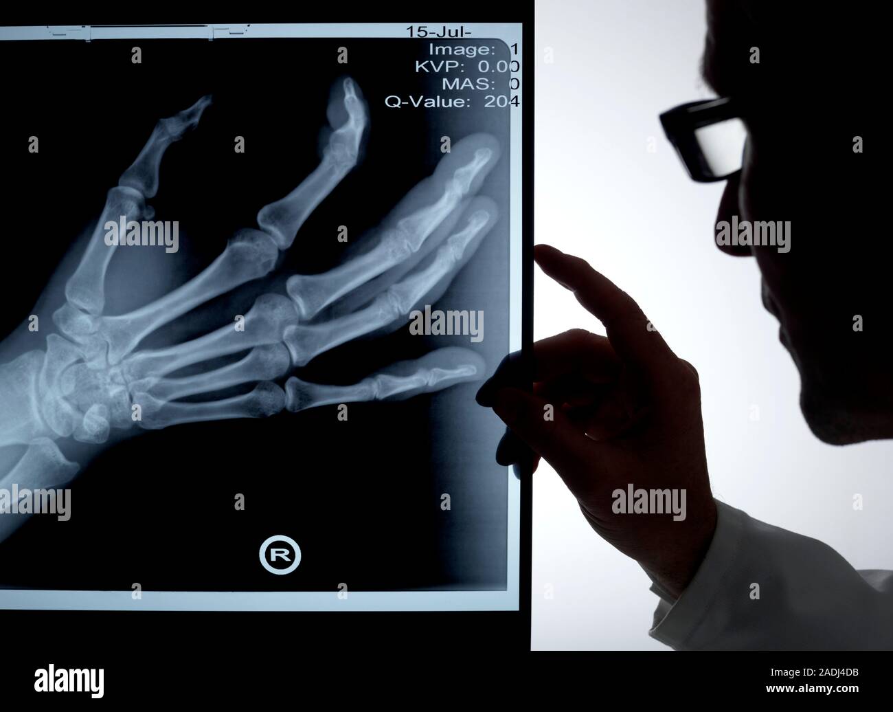 MODEL RELEASED. X-ray diagnosis. Doctor examining an X-ray of a hand ...