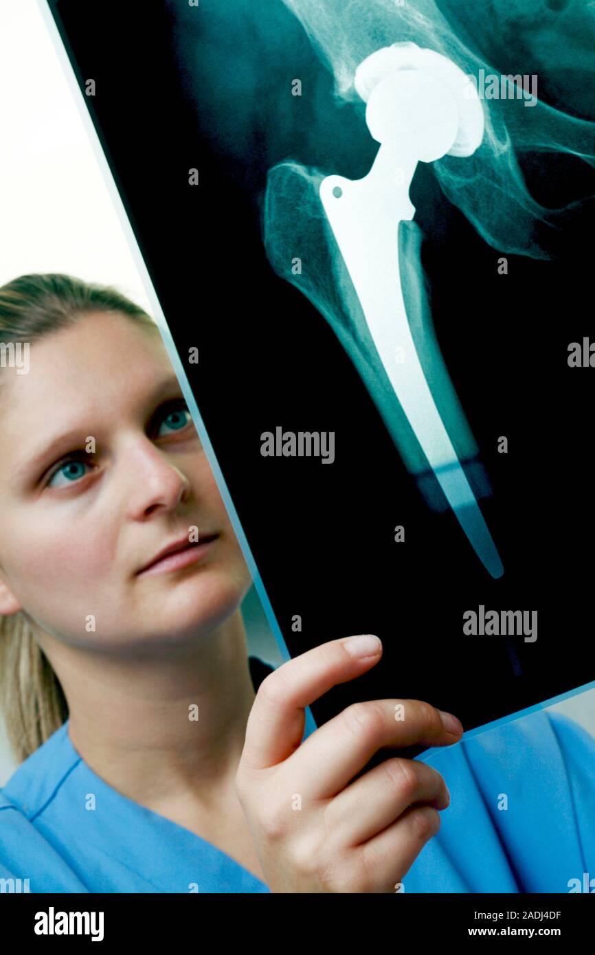 Radiographer studying an X-ray of a pelvis with artificial hip joints ...