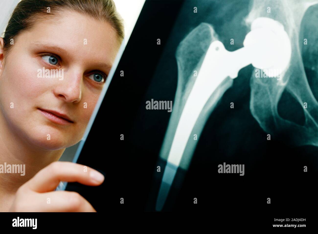 Radiographer studying an X-ray of a pelvis with artificial hip joints ...