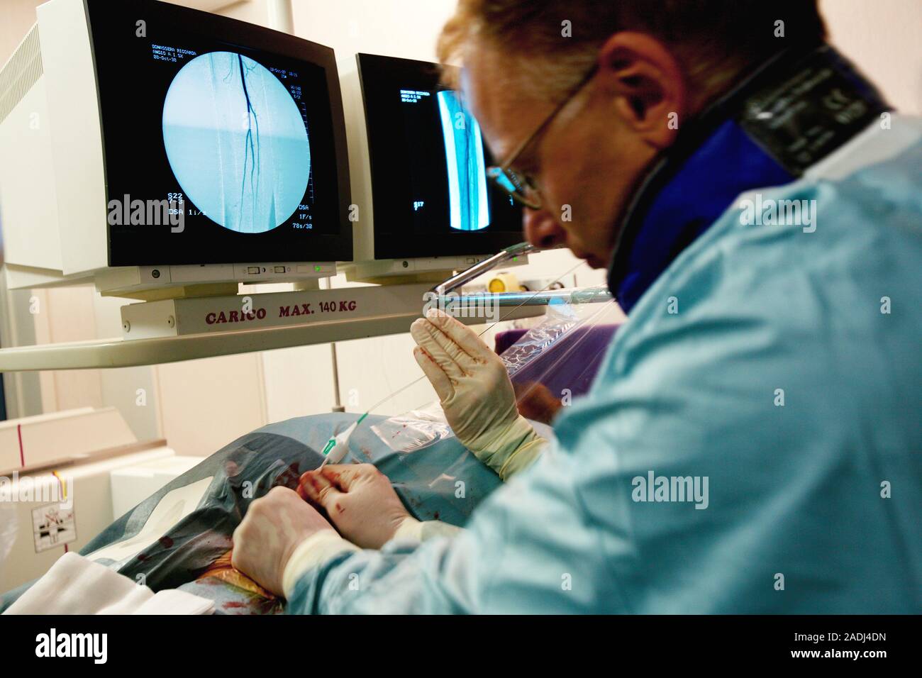 Angiography. Surgical team performing an angiography on a patient. X ...