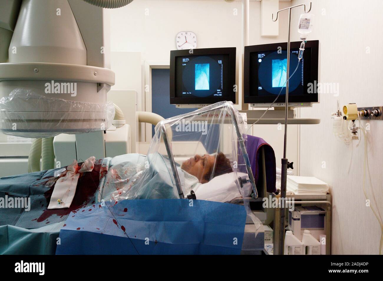 Angiography. Patient undergoing angiography surgery. X-ray images of ...