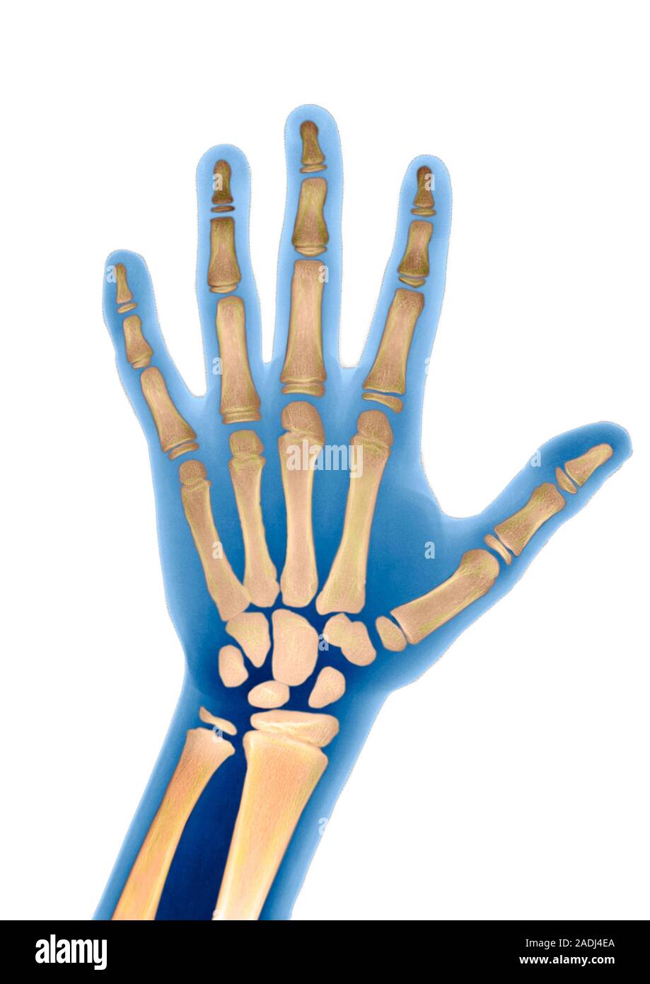 Coloured X-ray of the normal hand of a 12 year old child. The eight ...