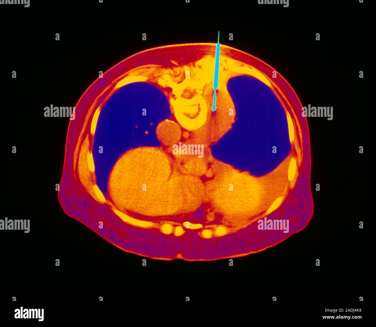 Lung biopsy. Coloured Computed Tomography (CT) scan of an axial section ... Lung biopsy. Coloured Computed Tomography (CT) scan of an axial section ...