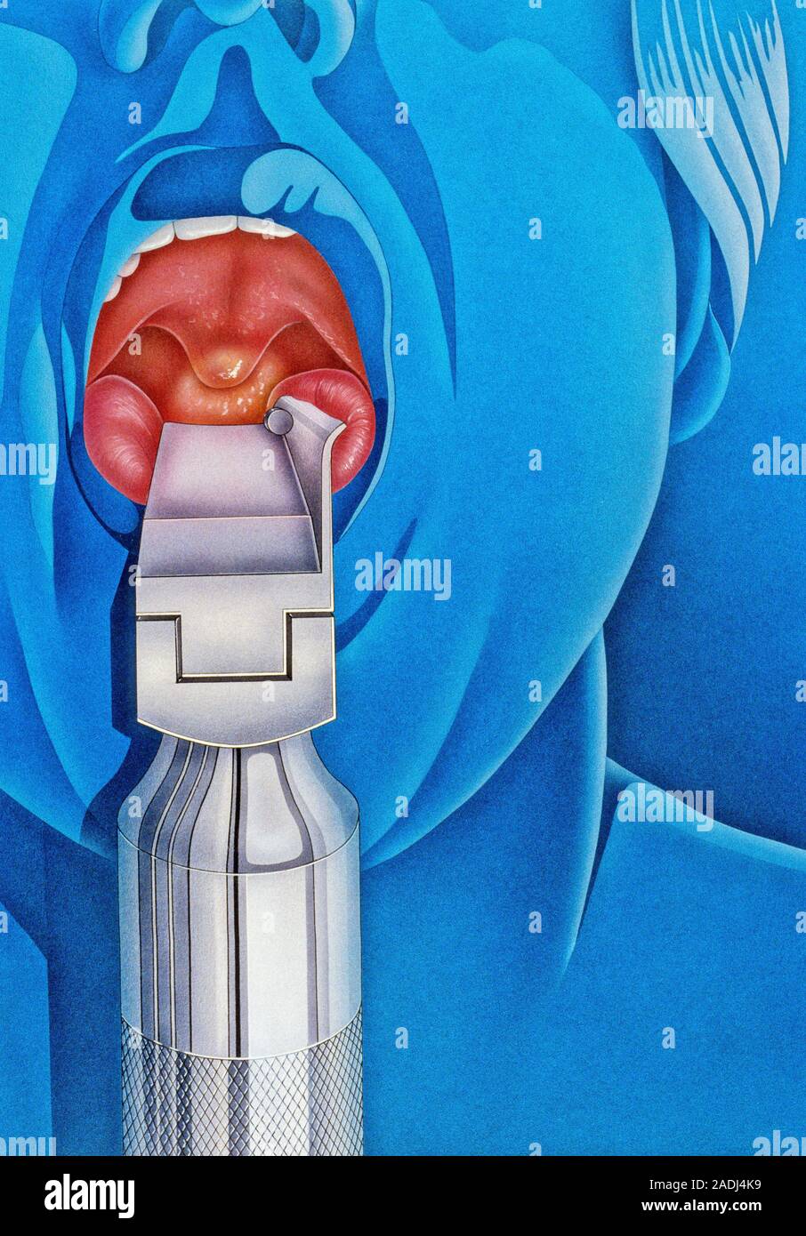 Laryngoscopy. Illustration showing the use of a laryngoscope, a type of ...
