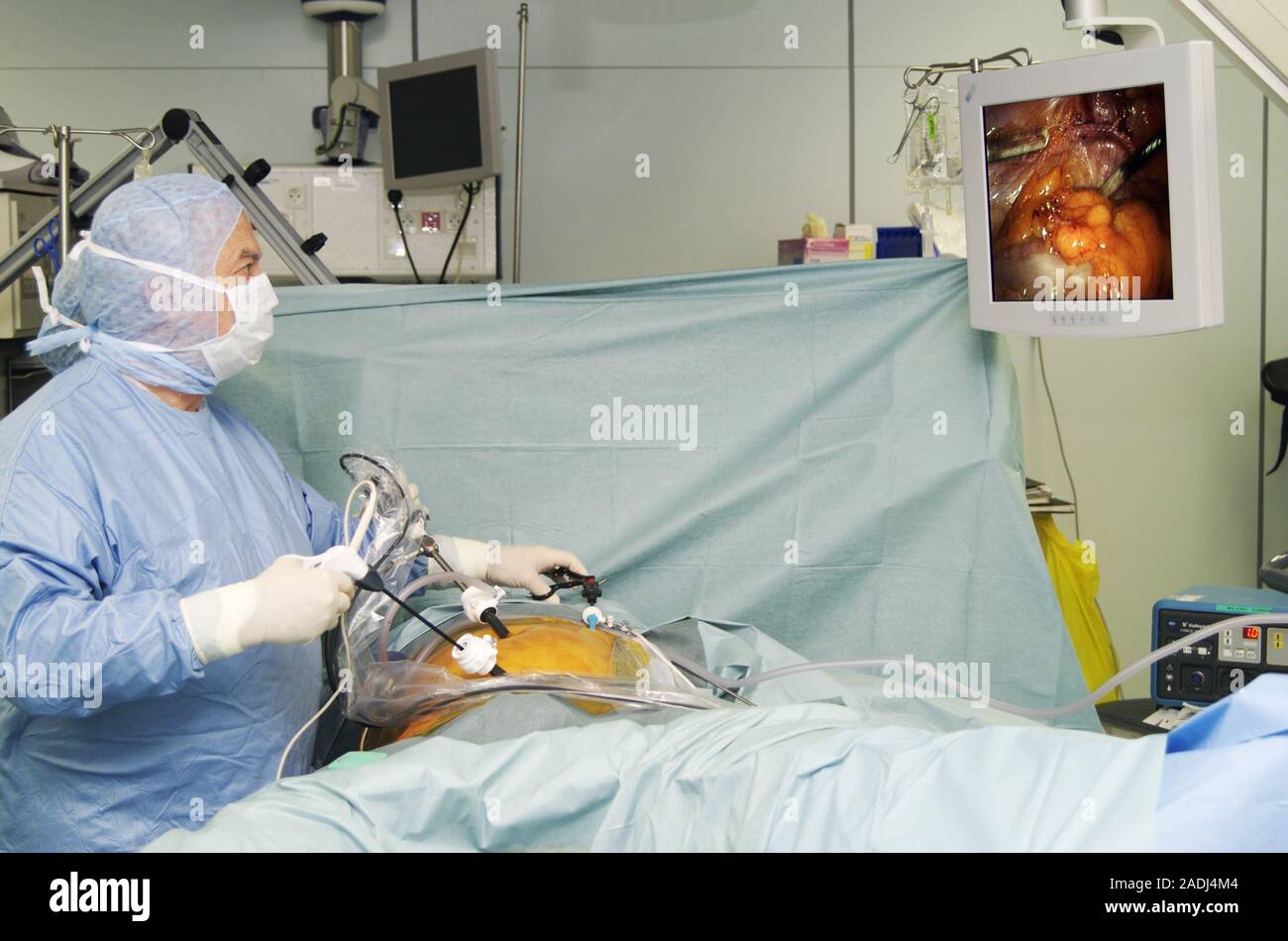 Colocolostomy. Surgeon performing a colocolostomy on a patient with ...