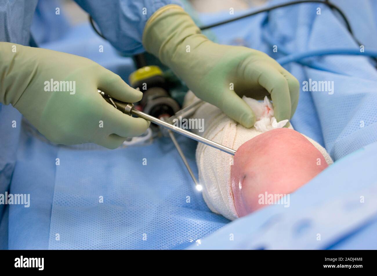 Knee biopsy surgery. Arthroscope being inserted into a patient's knee ...