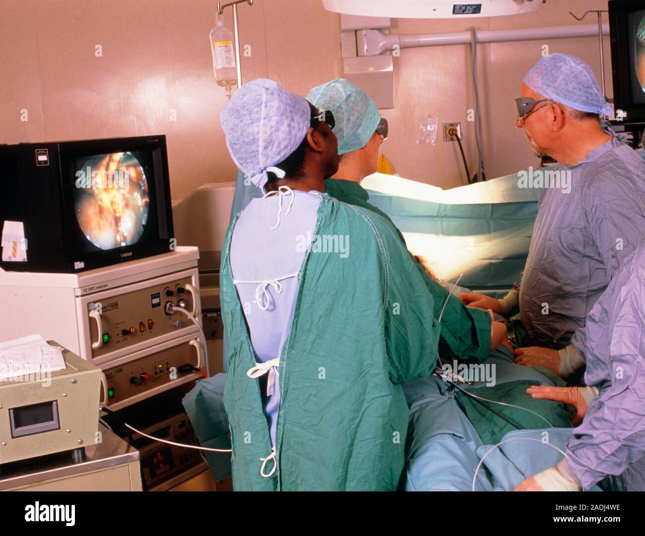 Model released. Surgeons removing the gallbladder (cholecystectomy ...