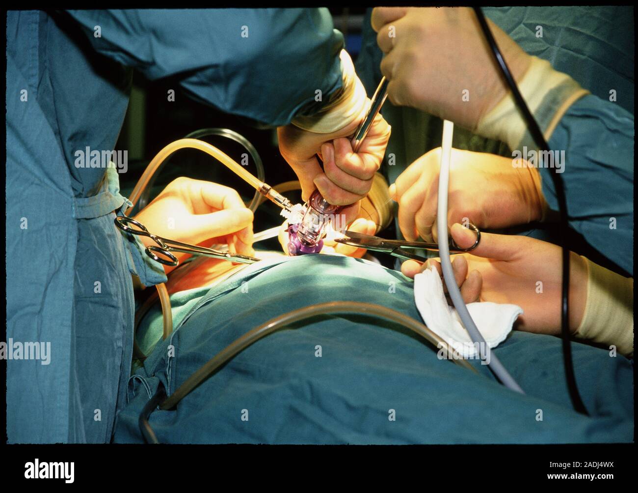 Laparoscopy. View of surgeons' gloved hands positioning a laparoscope ...