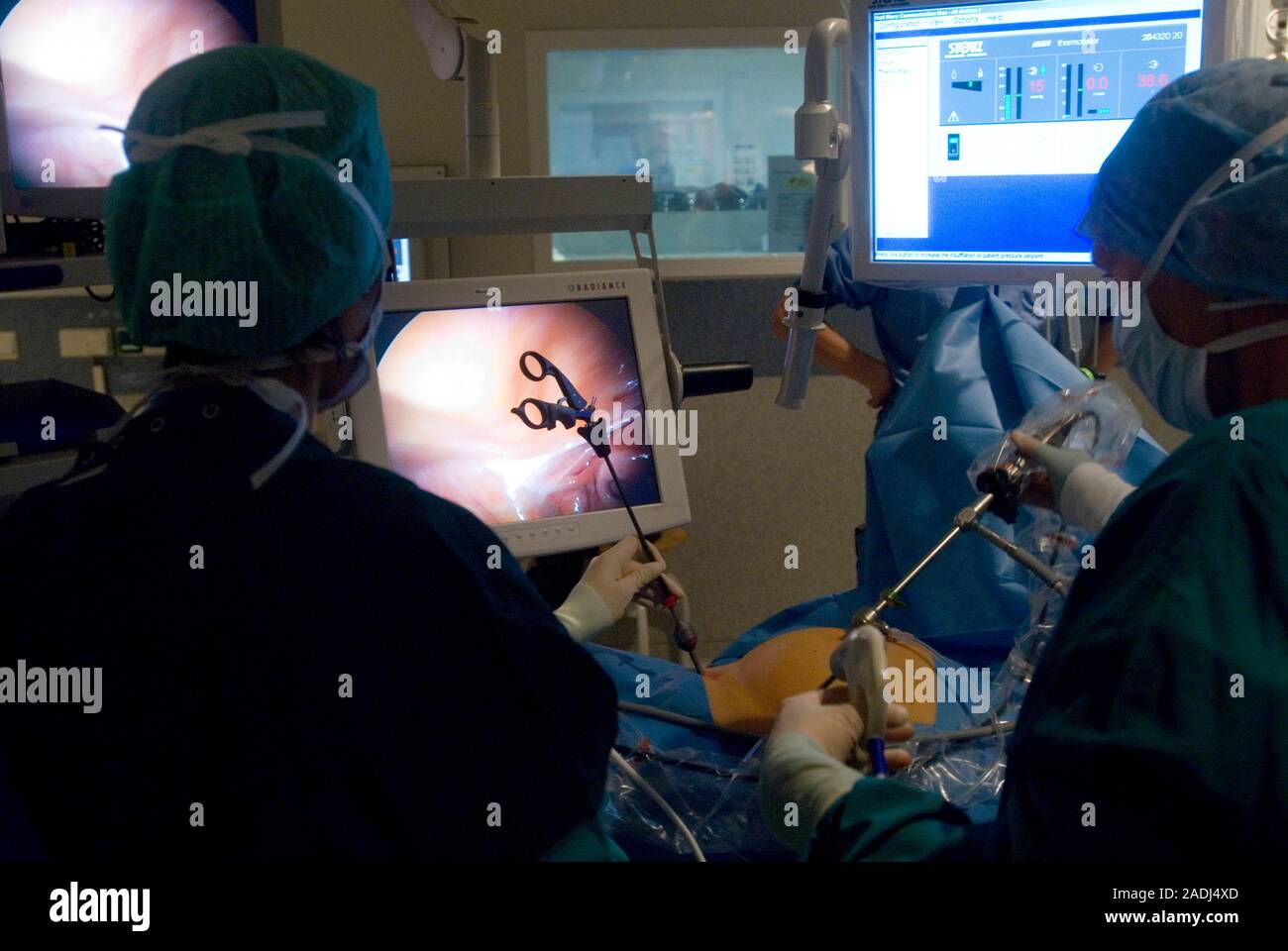 Keyhole surgery. Surgeons performing abdomininal keyhole surgery on a ...
