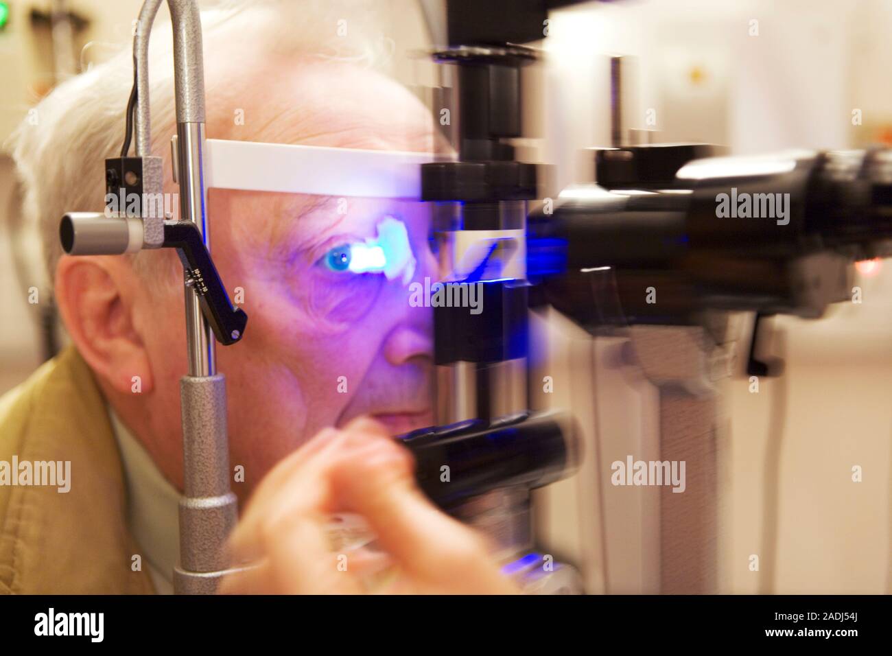 MODEL RELEASED. Eye examination. Patient with mild iritis (inflammation ...