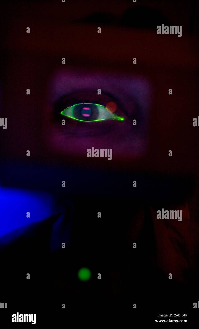 MODEL RELEASED. Eye examination. A sodium flourescence dye (green) has ...