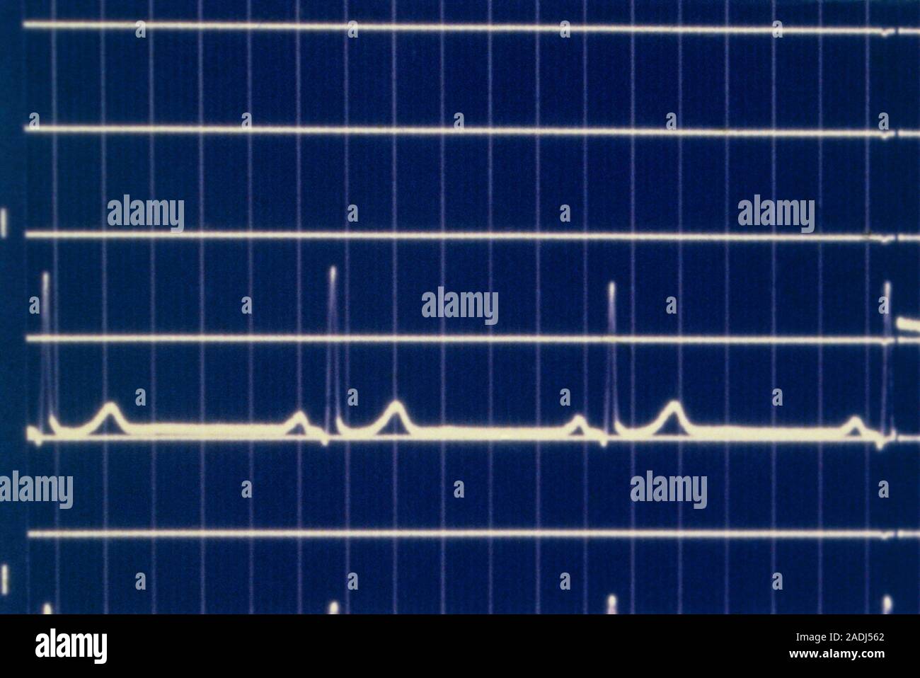 Normal electrocardiogram (ECG) pattern Stock Photo - Alamy