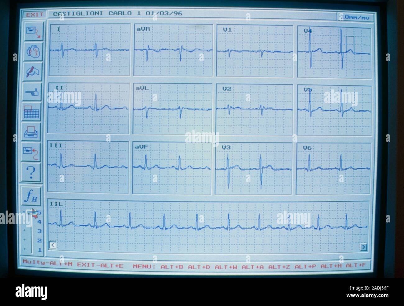 Electrocardiograph. Computer screen display of electrocardiograph ...
