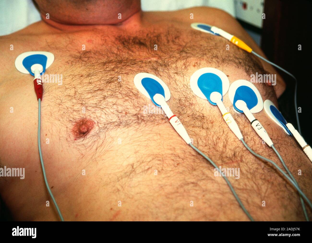 ECG electrodes. Electrodes attached to a patient's chest during an ...