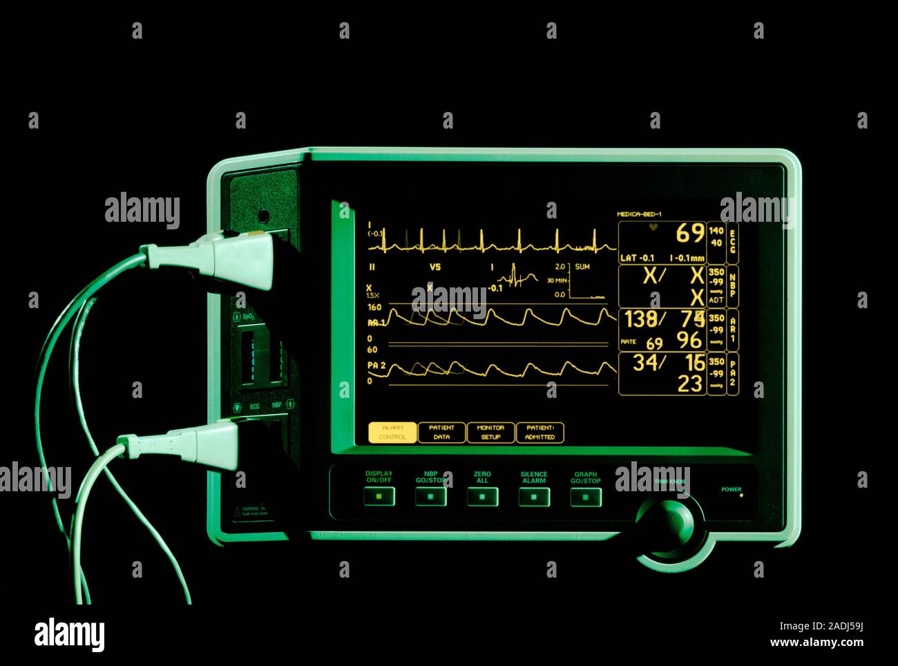 Heart monitor in use. This display shows the vital signs of a patient ...