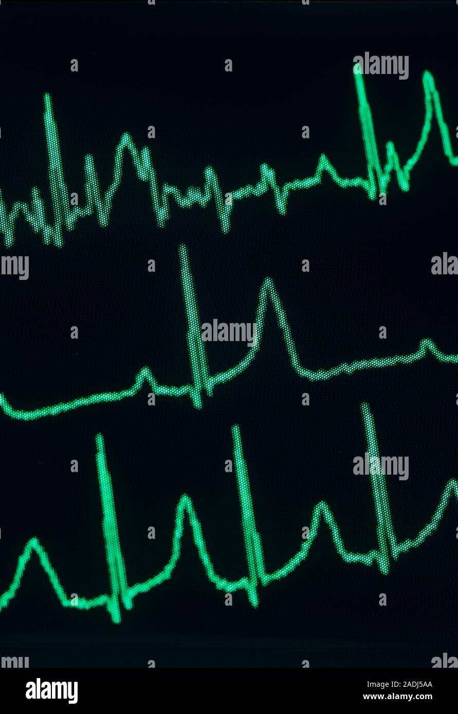 Electrocardiogram (ECG) indicating complete (third-degree) (AV ...