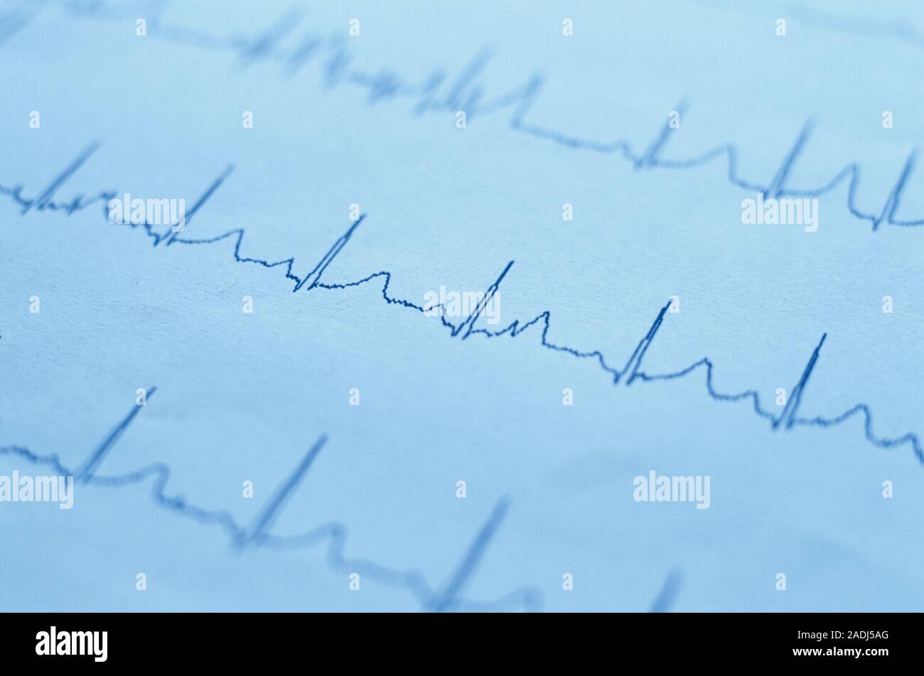 Electrocardiogram (ECG) of a normal heart rate. An ECG measures the ...