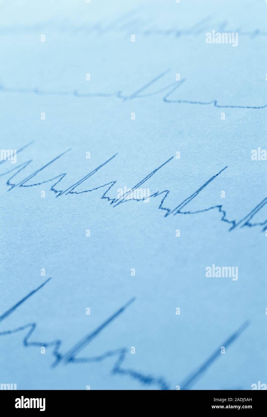 Electrocardiogram (ECG) of a normal heart rate. An ECG measures the ...