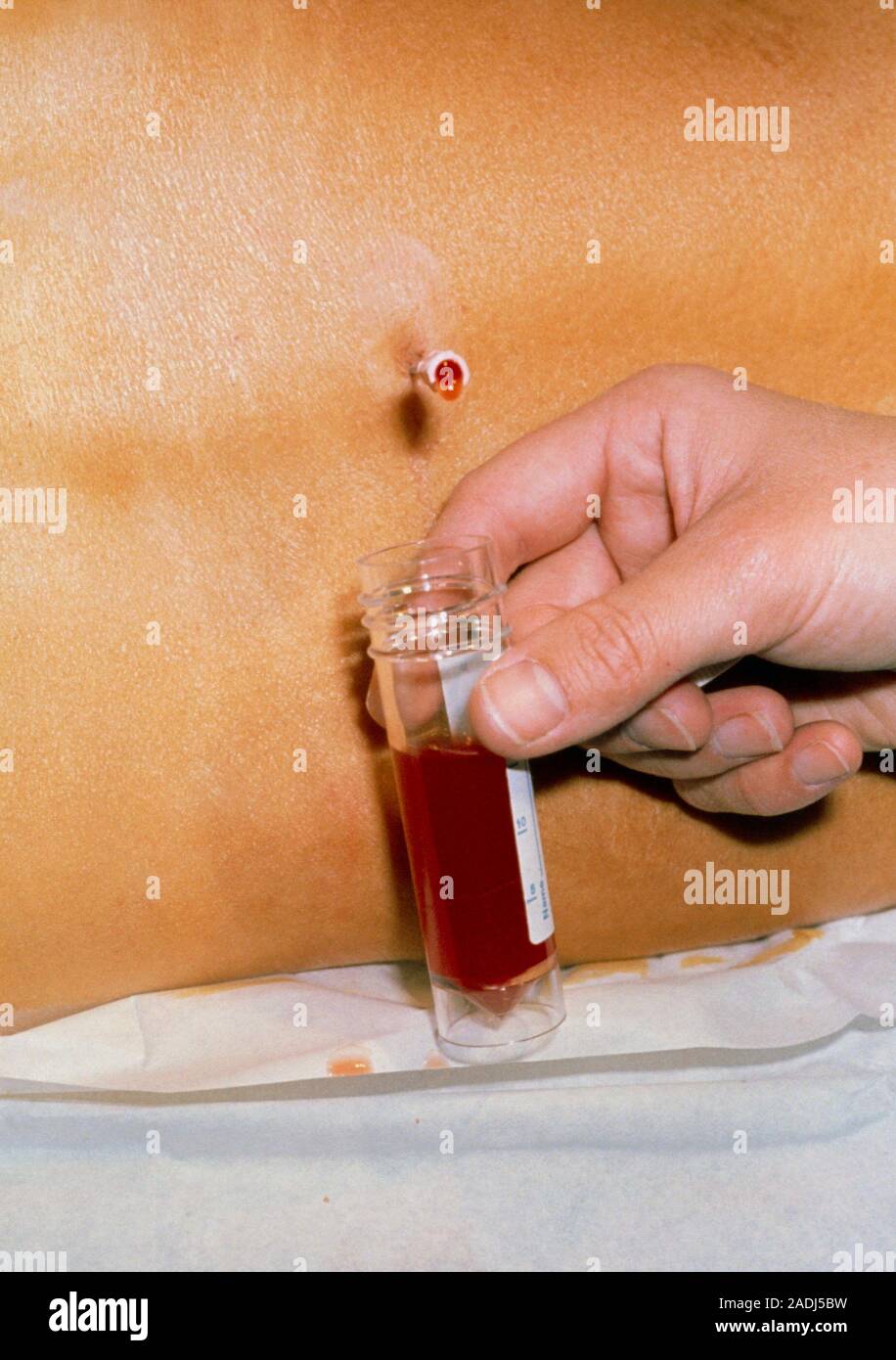 Lumbar puncture being performed. Cerebrospinal fluid is withdrawn by ...