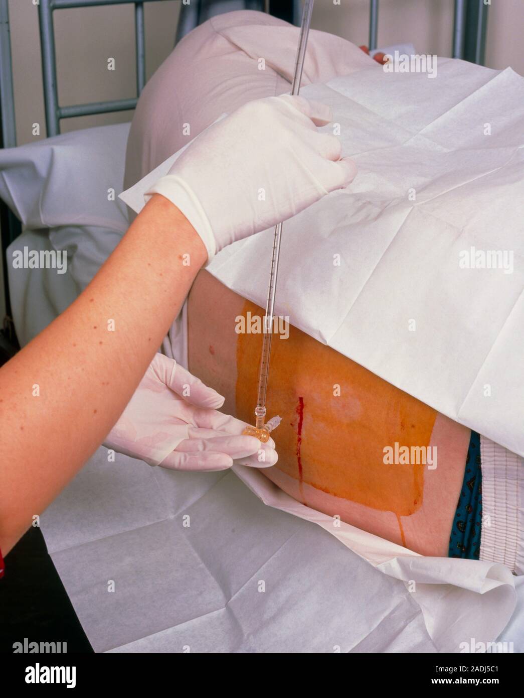 Cerebrospinal fluid pressure. The hands of a hospital doctor are seen ...