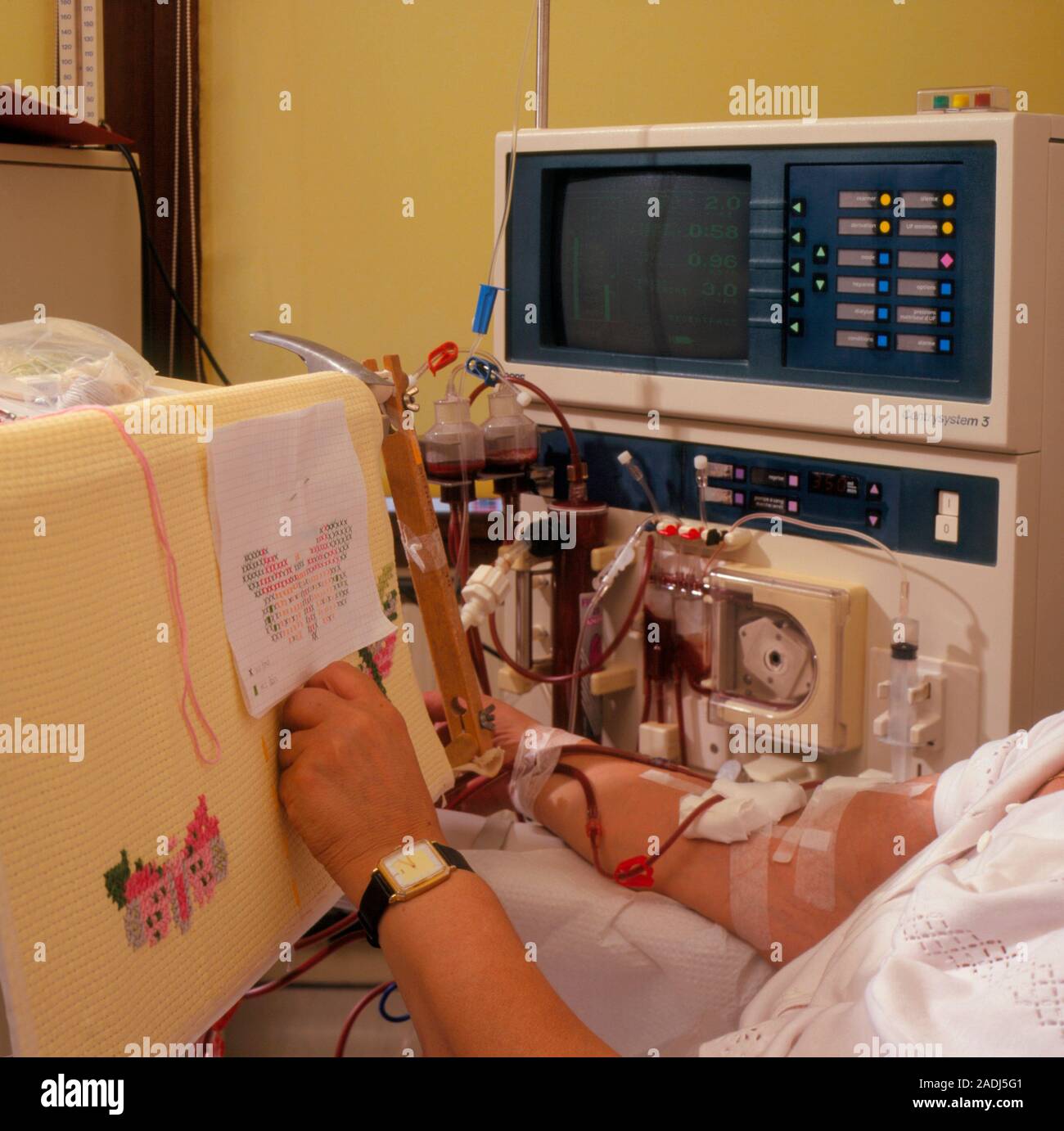 Kidney dialysis.Forearm of an elderly woman patient showing the tubing ...