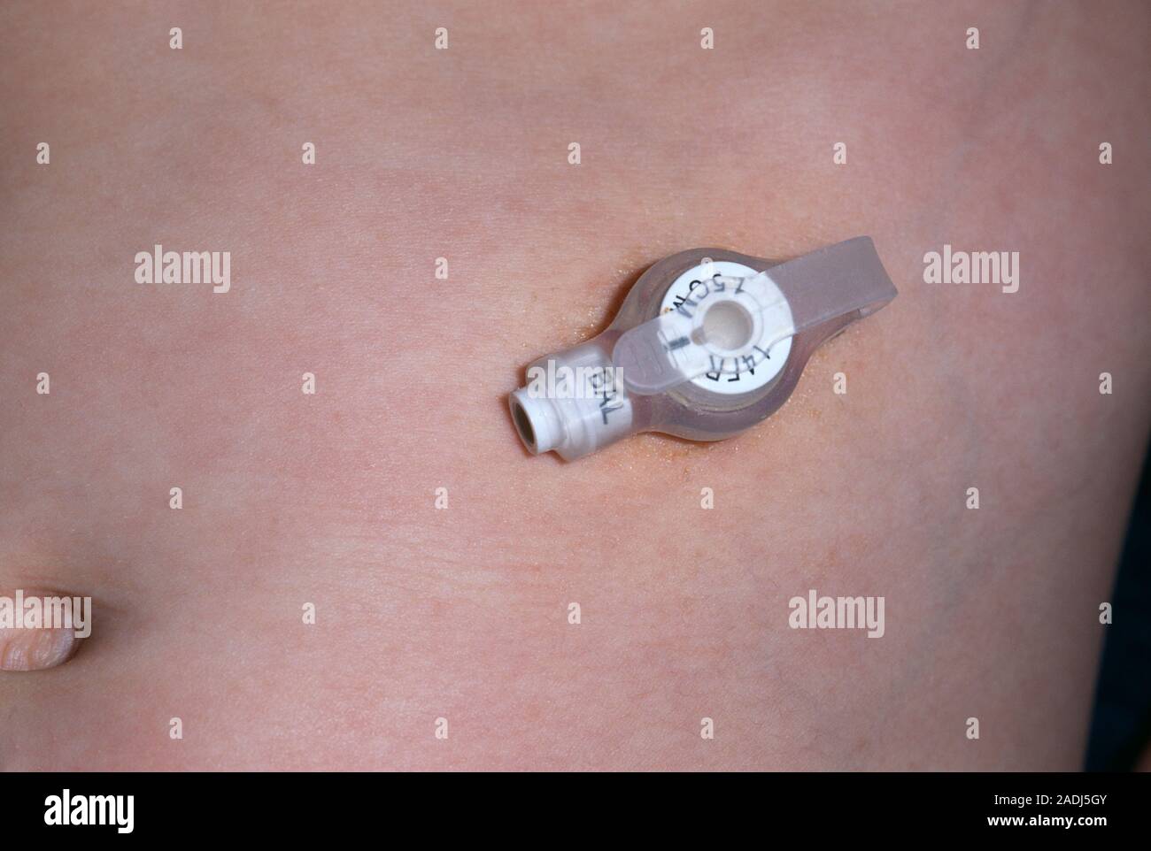 Gastrostomy tube in the stomach of a 3-year-old girl. This child was ...