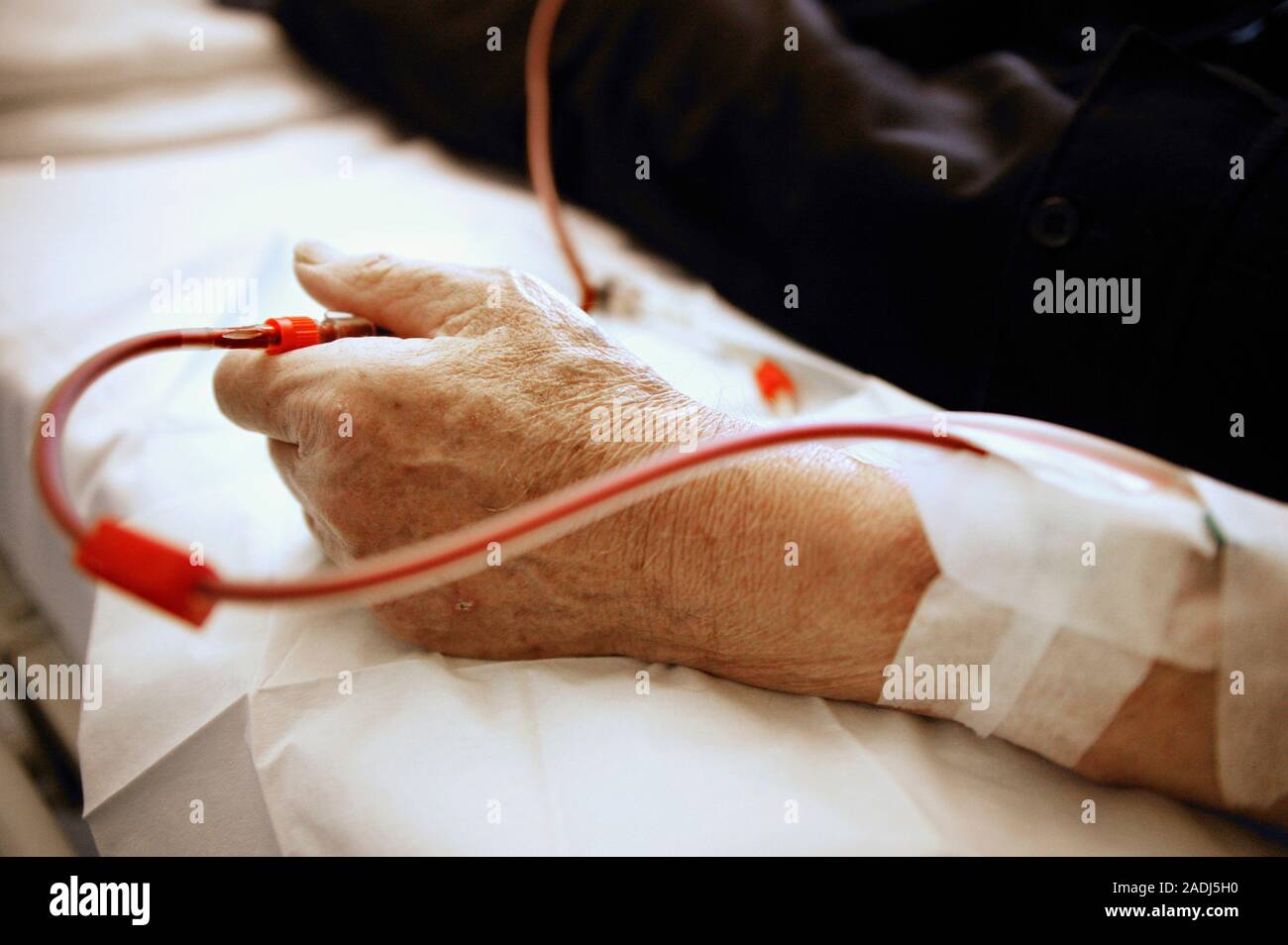 Kidney dialysis. Blood flowing down a tube from the forearm of a ...