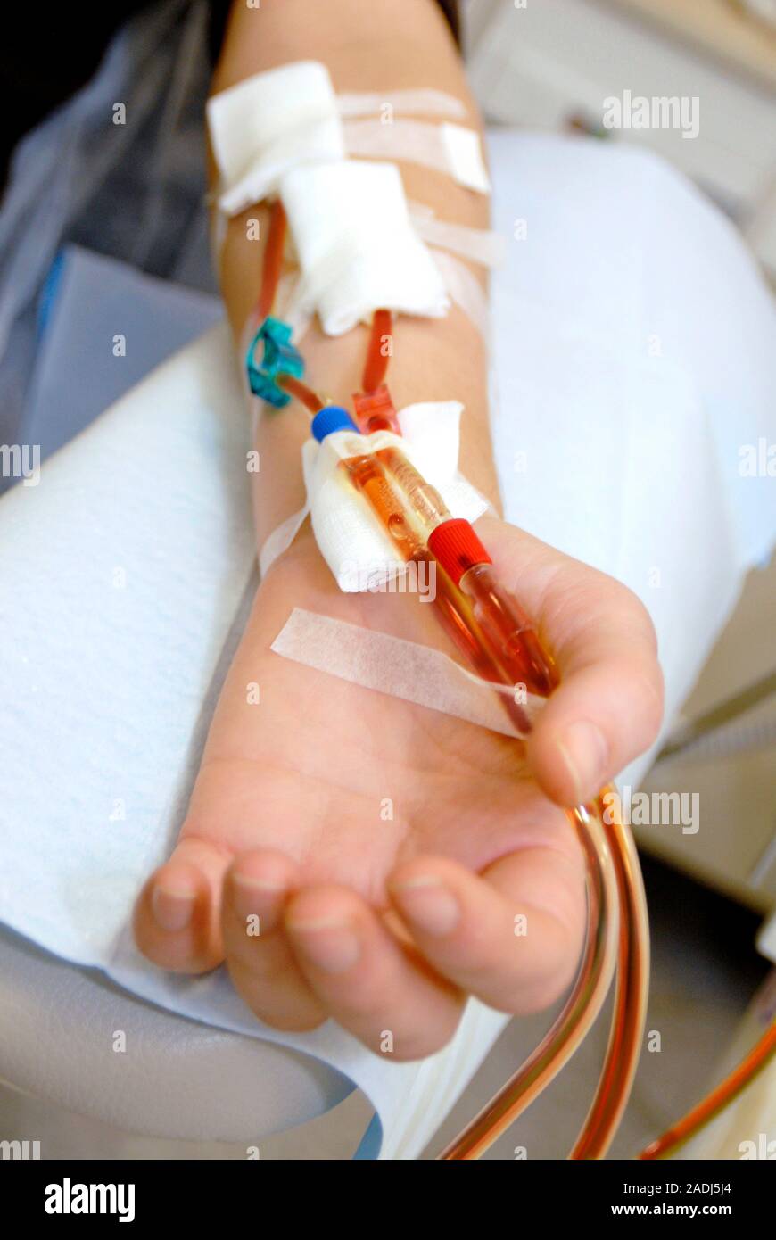Kidney dialysis. Close-up of the arm of a patient undergoing kidney ...