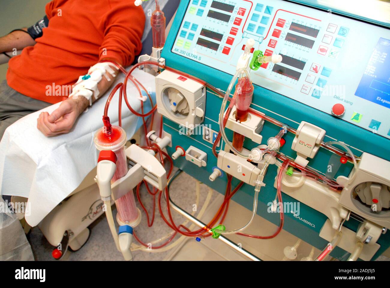 Dialysis machine. Patient attached to a dialysis machine, or dialyser ...