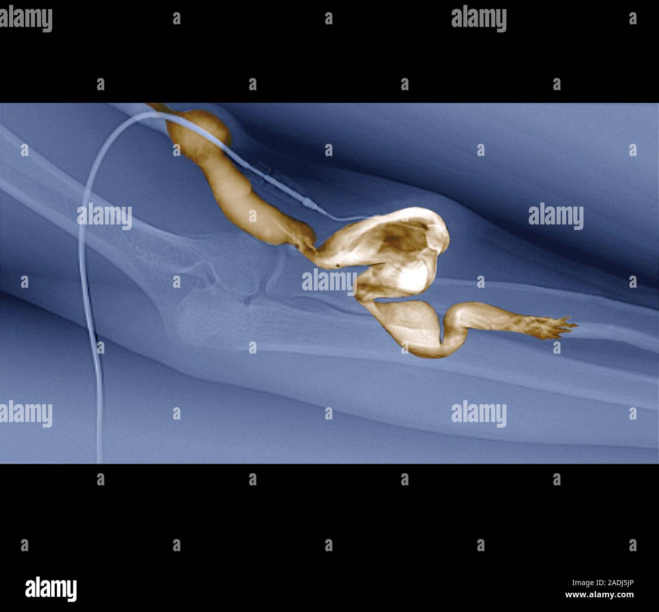 Blood clot in the arm. Coloured angiogram of a blot clot (thrombus ...