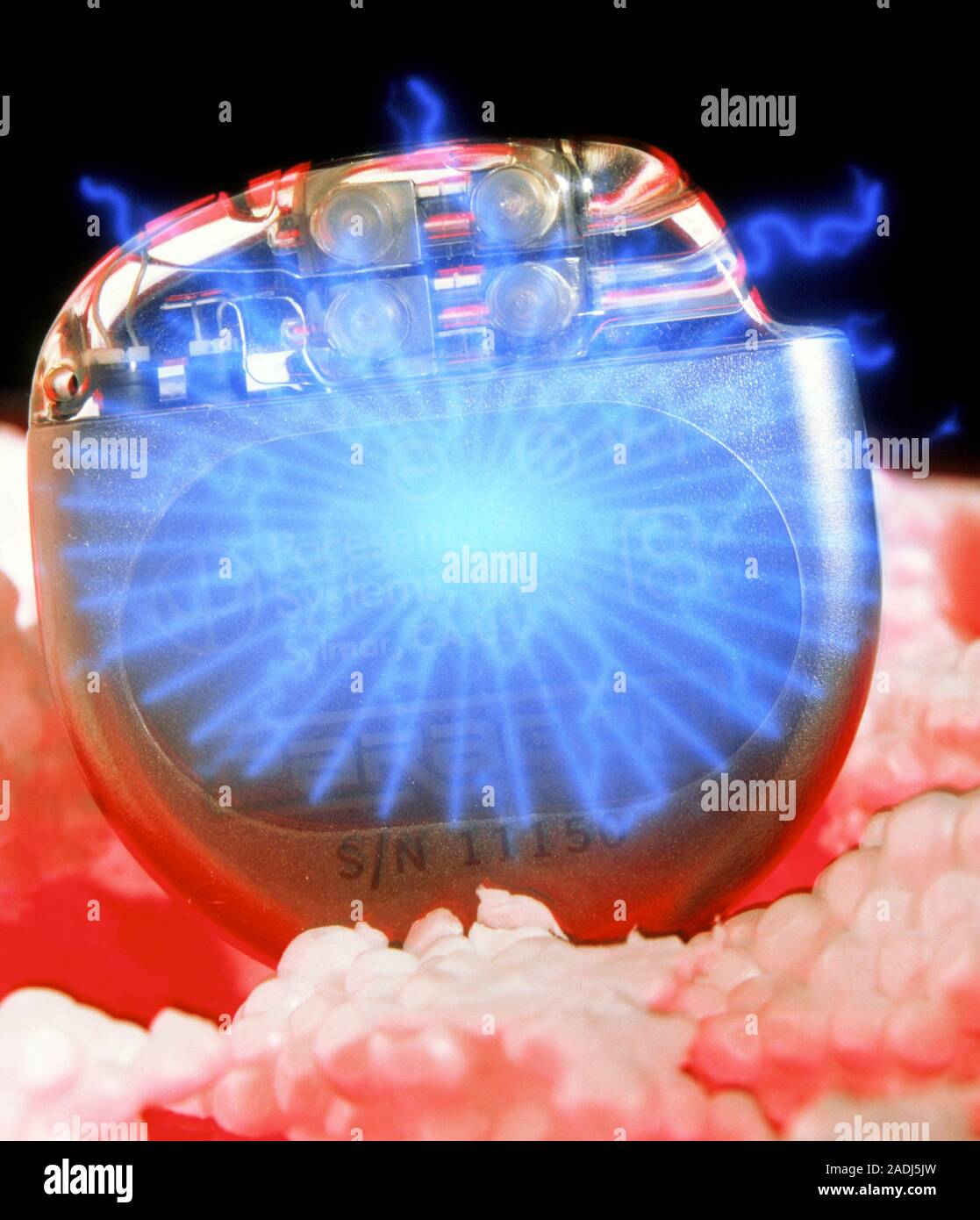 Special effects photo of a Paragon heart pacemaker, a battery-operated ...