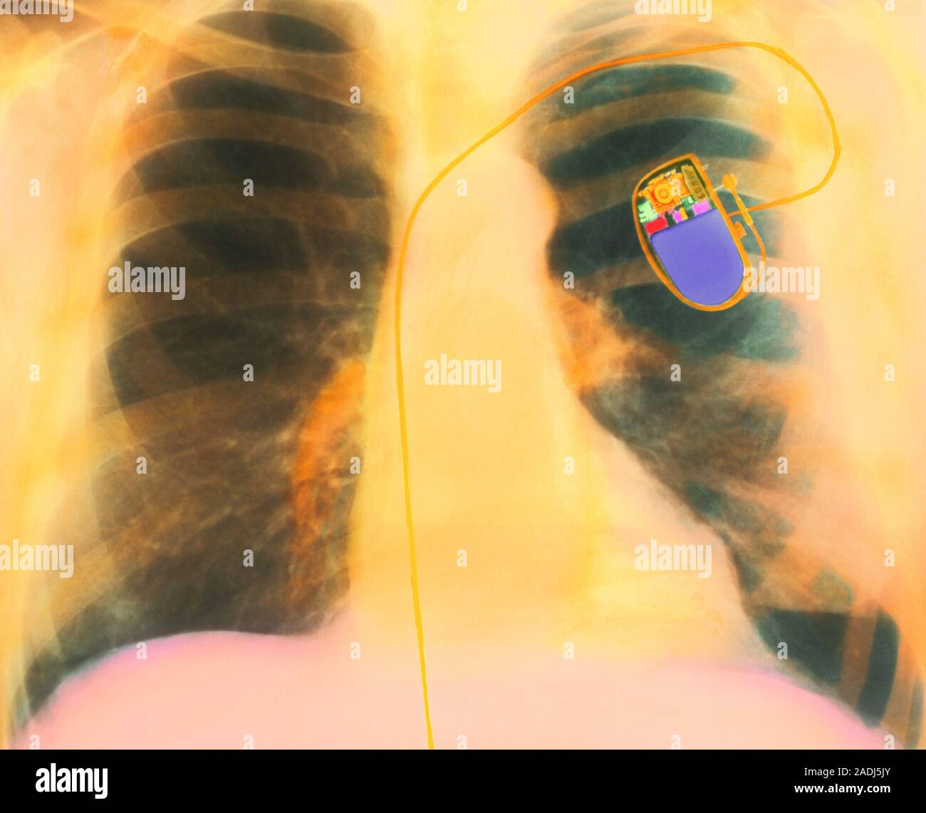 Heart pacemaker. Coloured X-ray of the chest of a patient, showing a ...