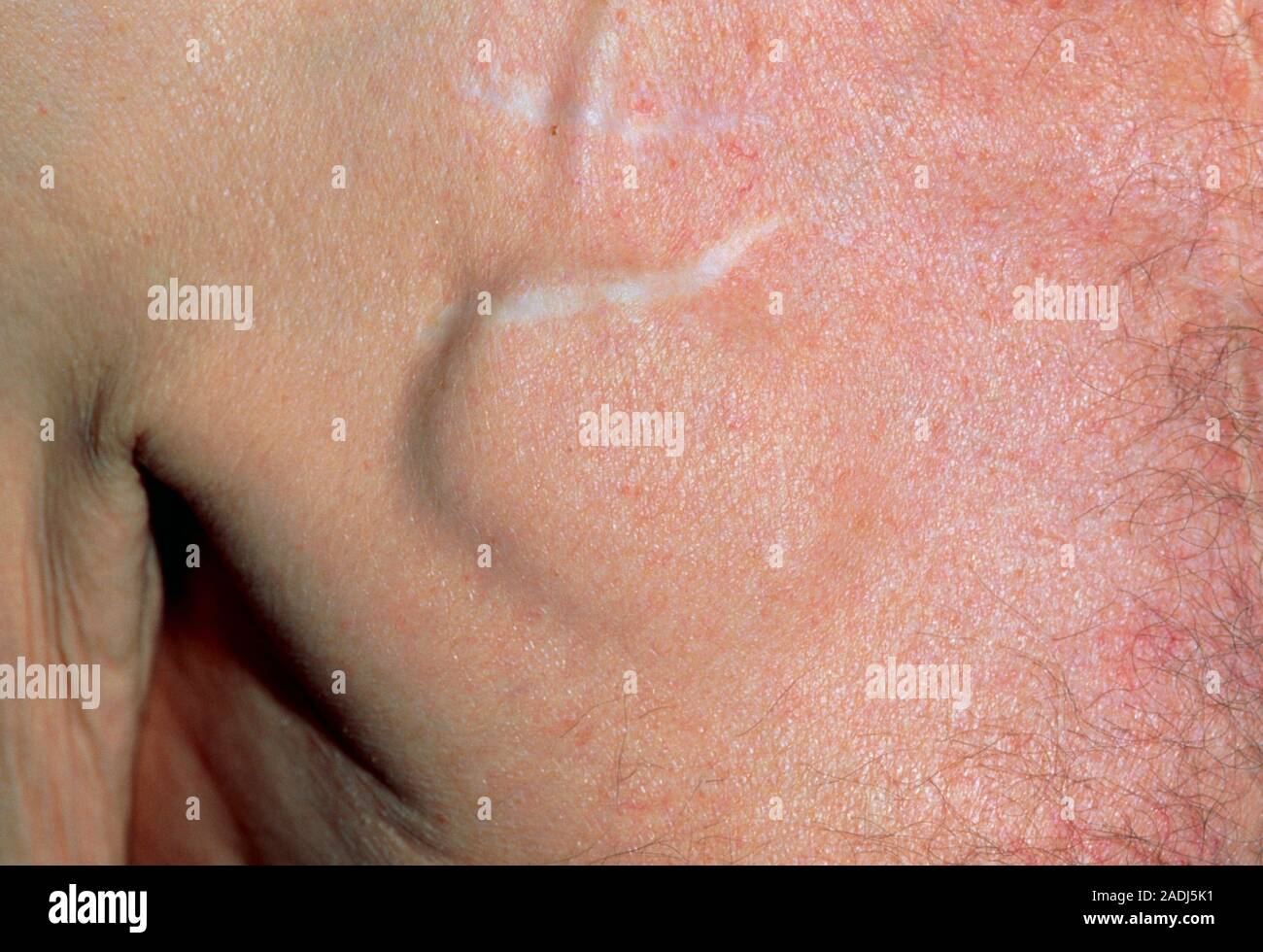 Pacemaker. A heart pacemaker implanted under the skin below the ...