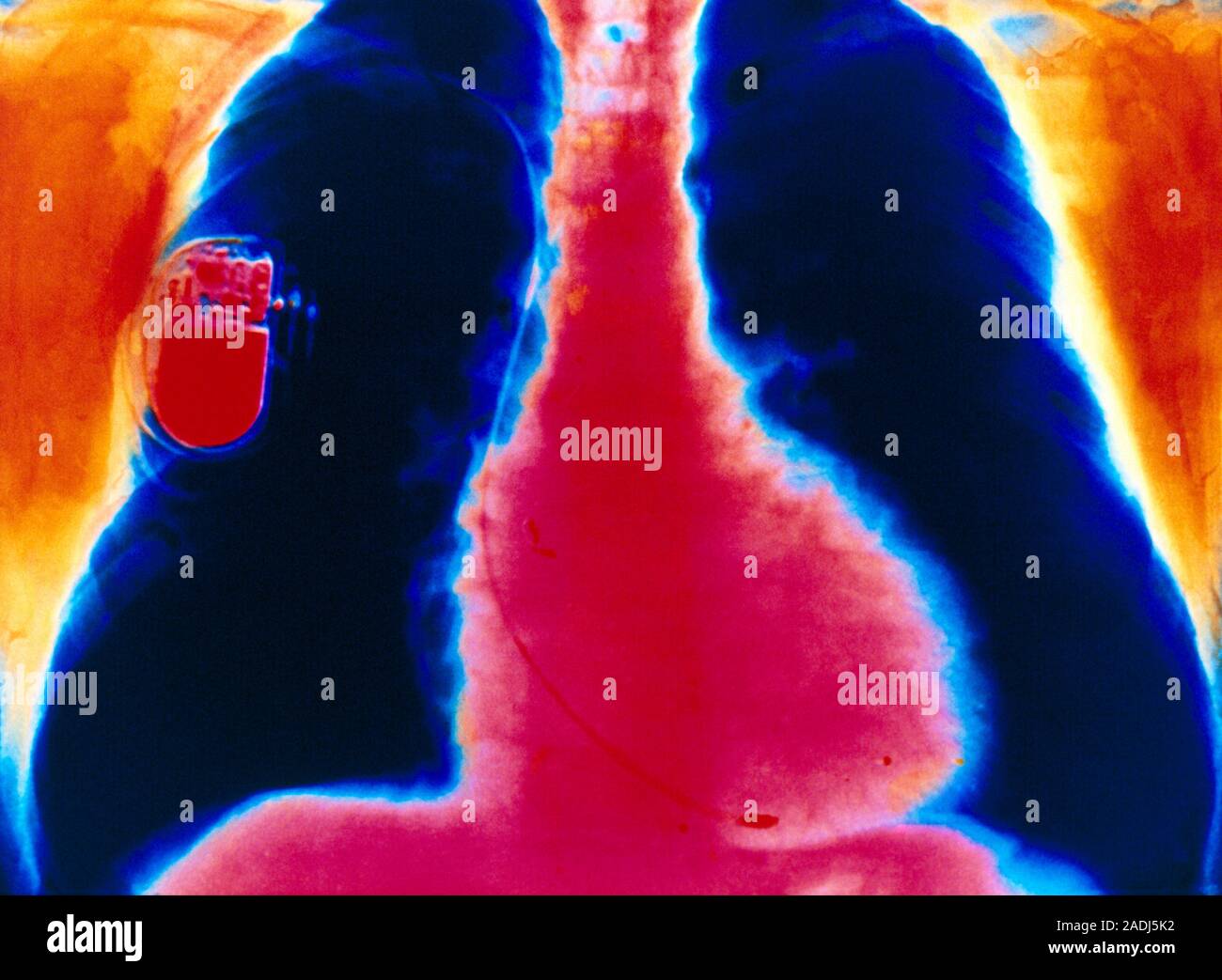 Pacemaker. Coloured X-ray of a heart pacemaker implanted in a patient's ...