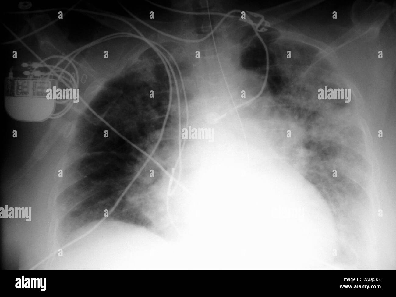 Heart pacemaker. Chest X-ray of a patient with an implanted heart ...