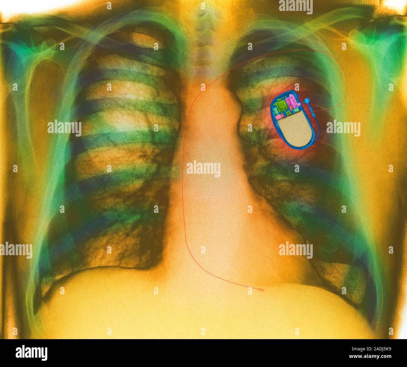 Heart pacemaker. Coloured X-ray of the chest of a patient, showing a ...